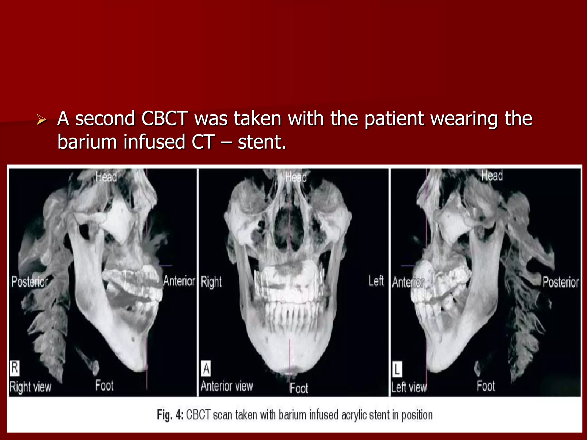 Benefits of cbct in implant planning | PPTX