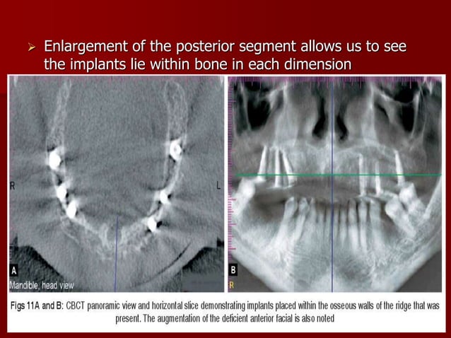 Benefits of cbct in implant planning | PPTX