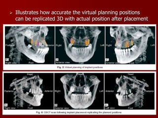 Benefits of cbct in implant planning | PPTX