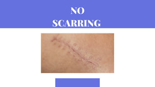 BENEFITS OF LAPAROSCOPIC URO-ONCOLOGY | PDF