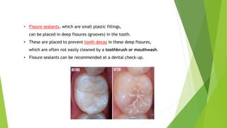 Benefits of regular dental checkup | PPTX