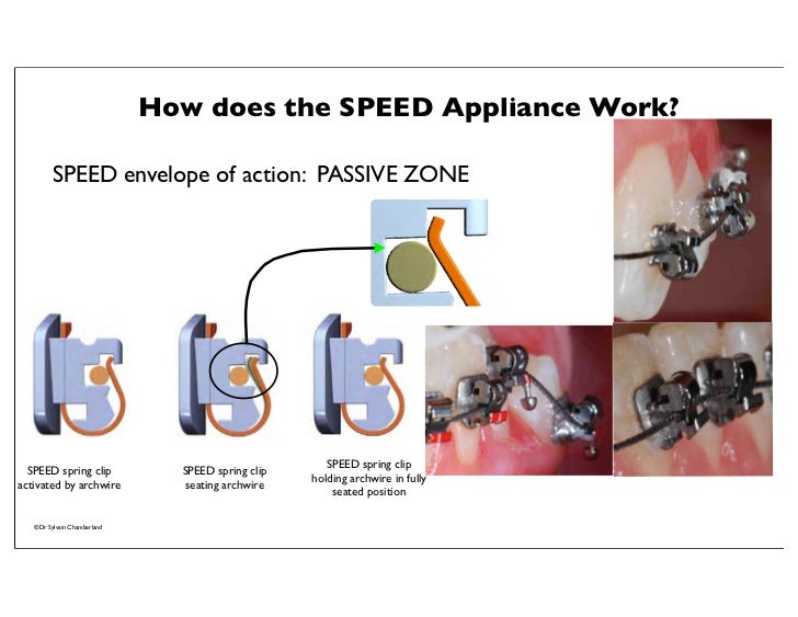 Benefits of SPEED bracket_Getting to Know the SPEED Appliance