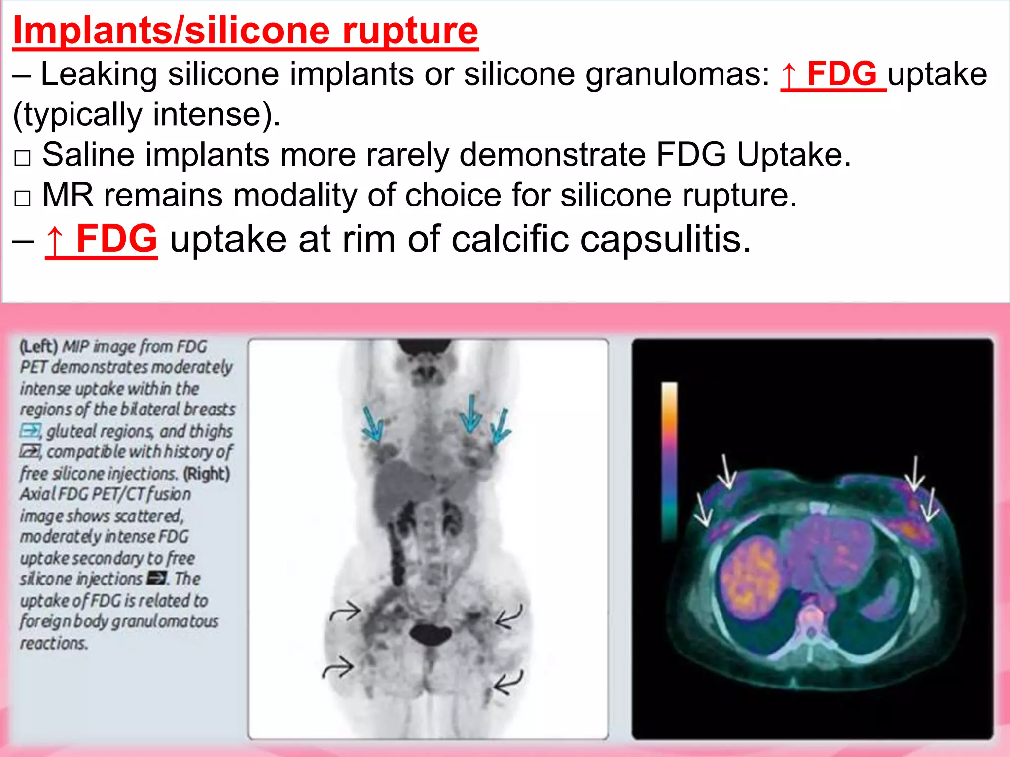 Bengin breast lesion in nuclear medicine | PPT