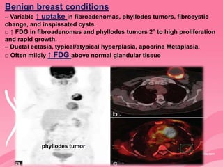 Bengin breast lesion in nuclear medicine | PPT | Cancer | Diseases and ...