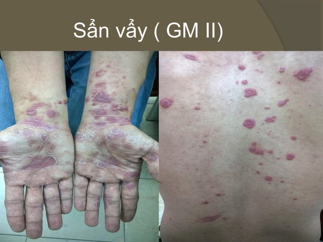 BỆNH GIANG MAI | PDF