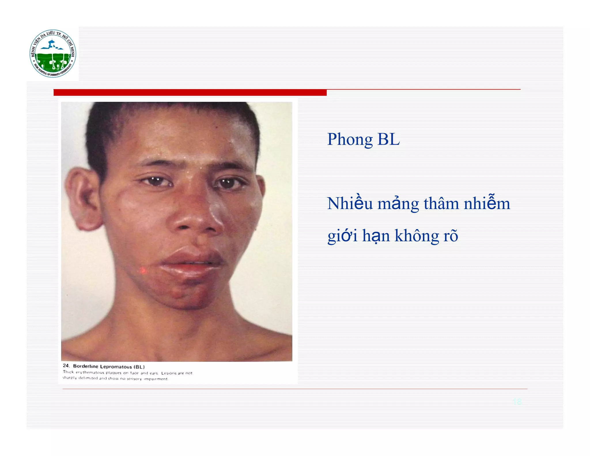 BỆNH PHONG | PDF