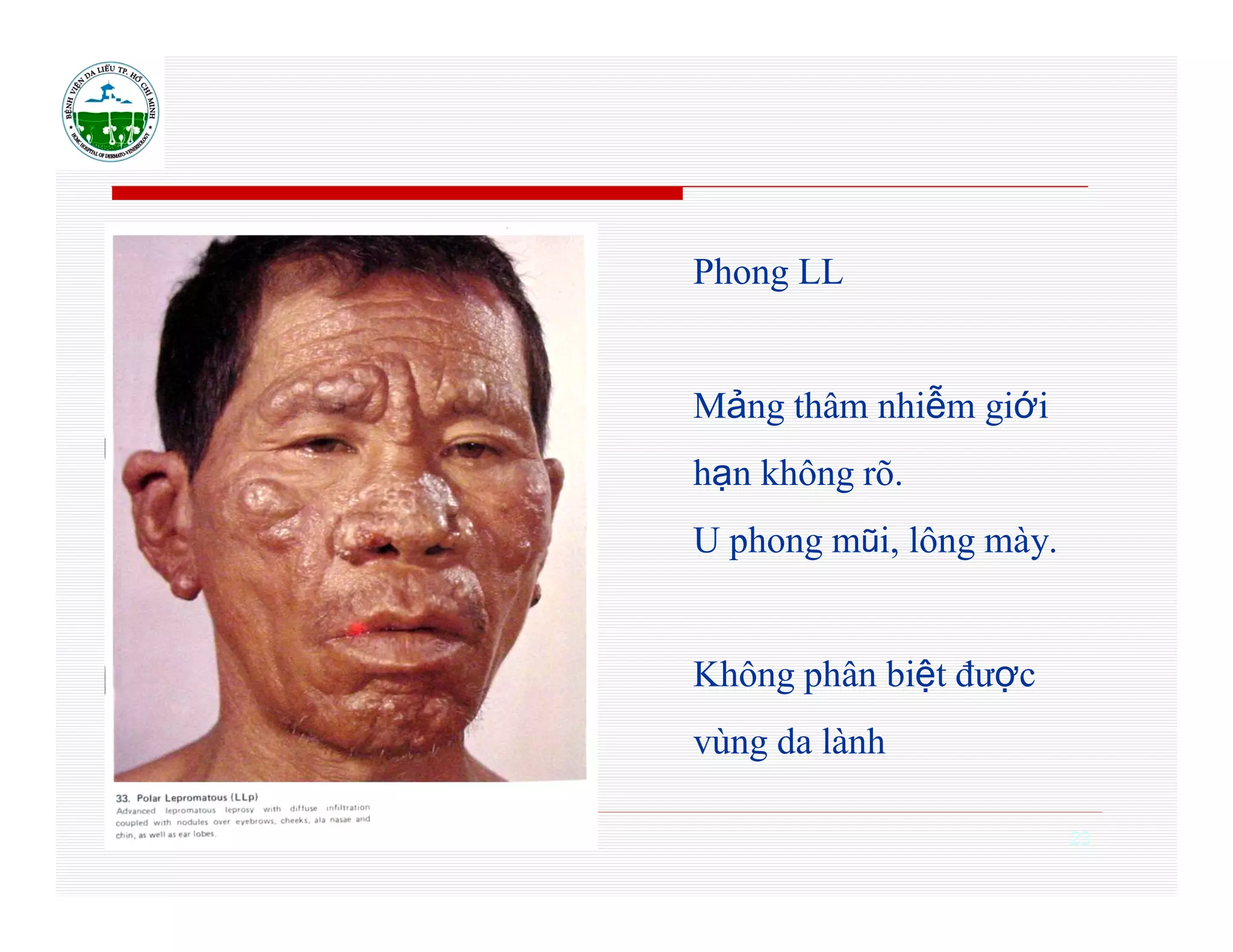 BỆNH PHONG | PDF