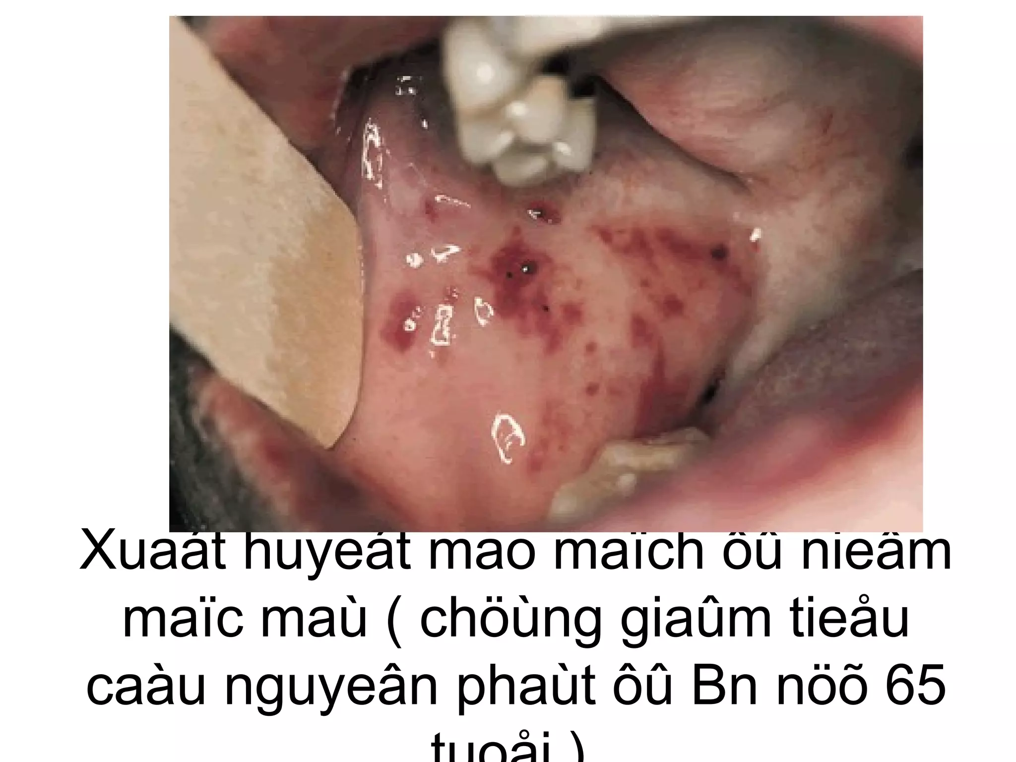 Benh ve mau & Bieu hien o mieng | PPT