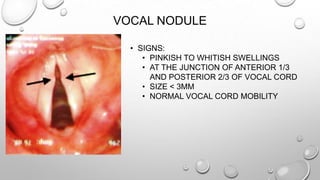 Benign lesions of larynx | PPTX