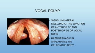 Benign lesions of larynx | PPTX