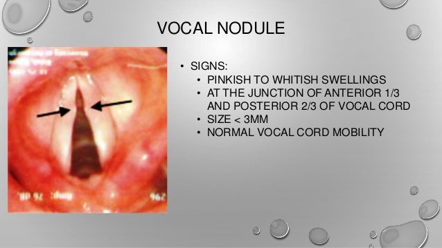 Vocal Cord Cancer