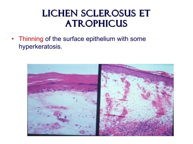 Benign diseases-of-the-vulvavagina-and - copy | PPT