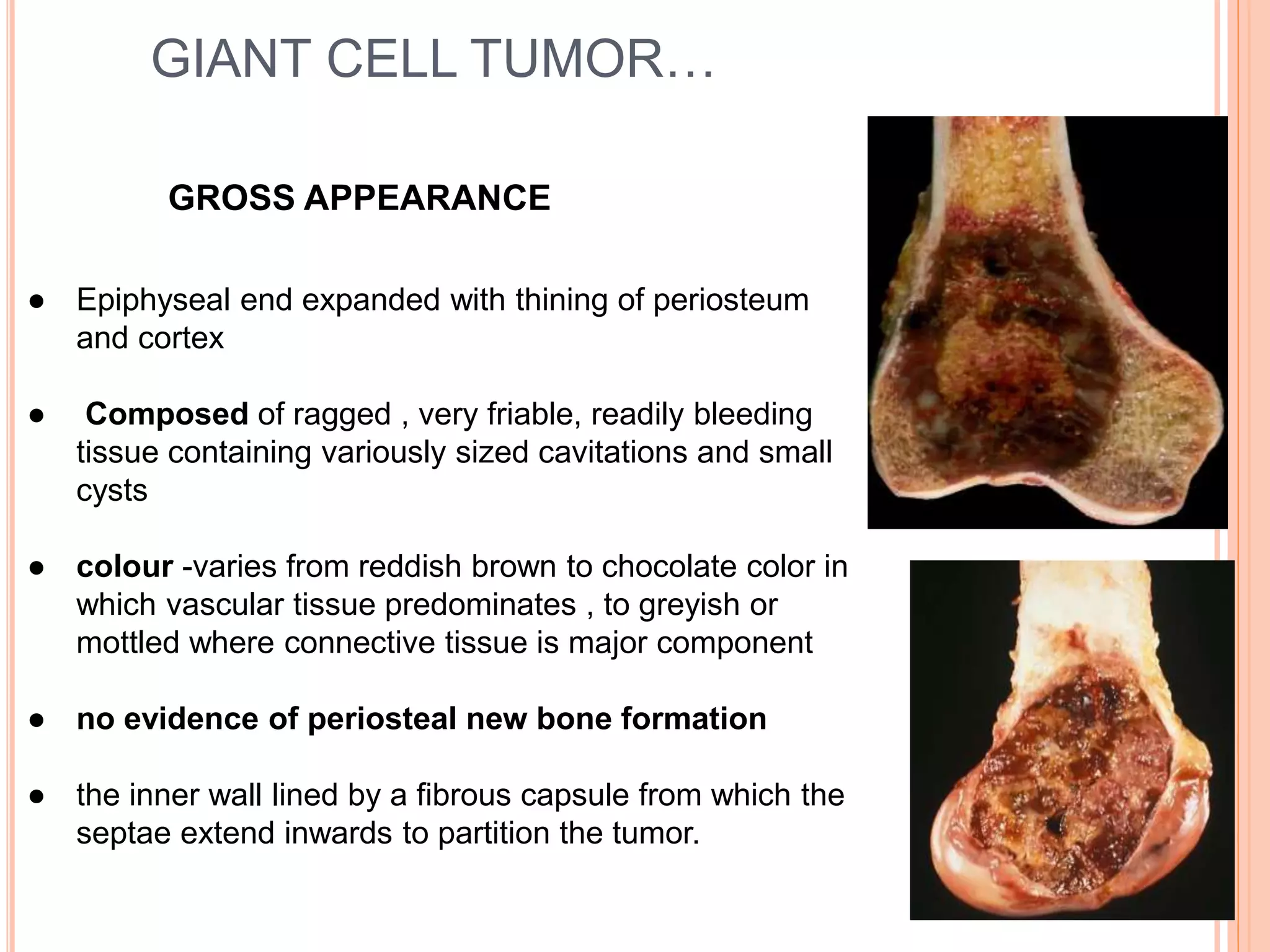 Benign aggressive bone tumor | PPTX