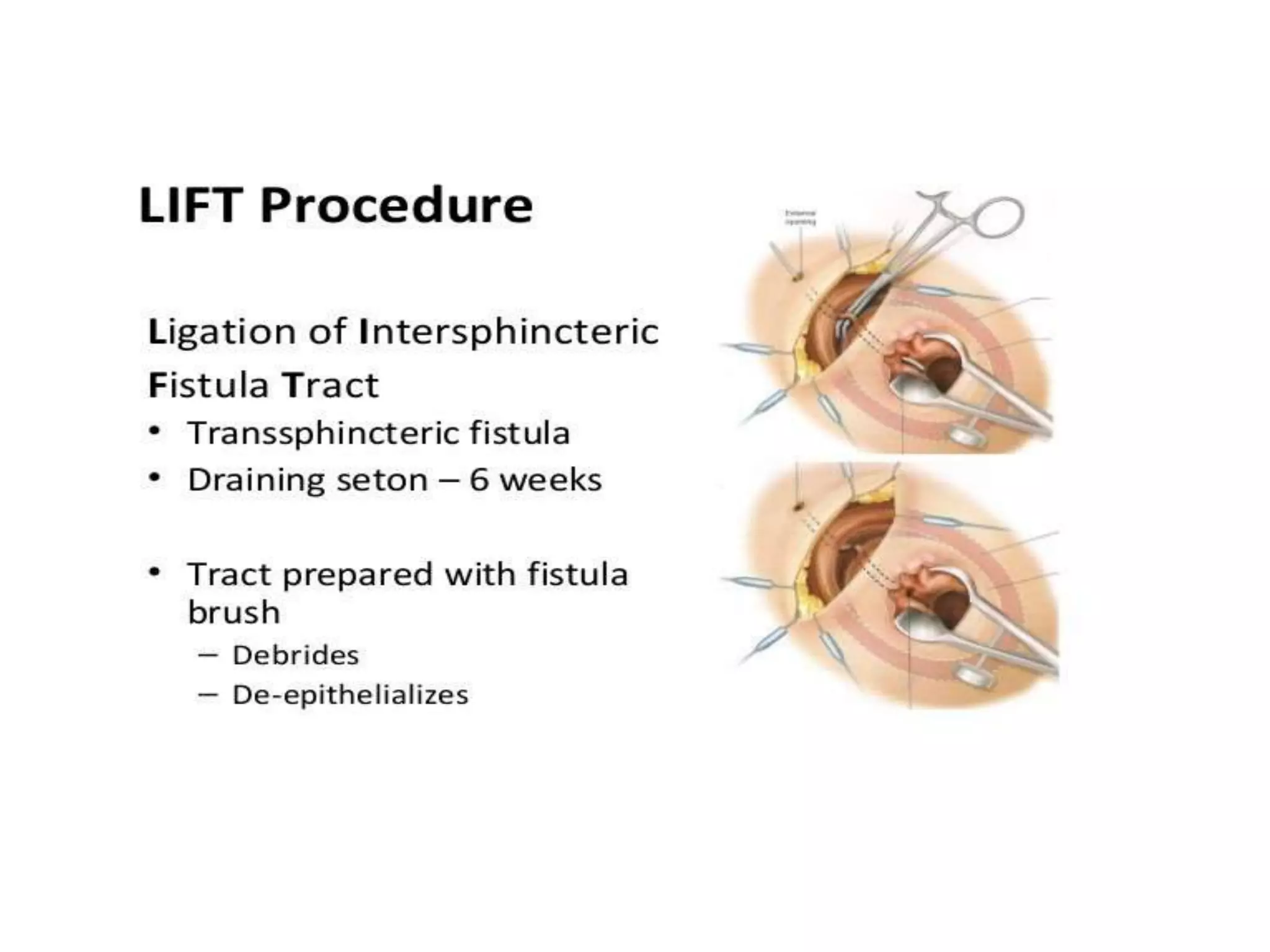 Benign anal and perianal conditions | PPTX