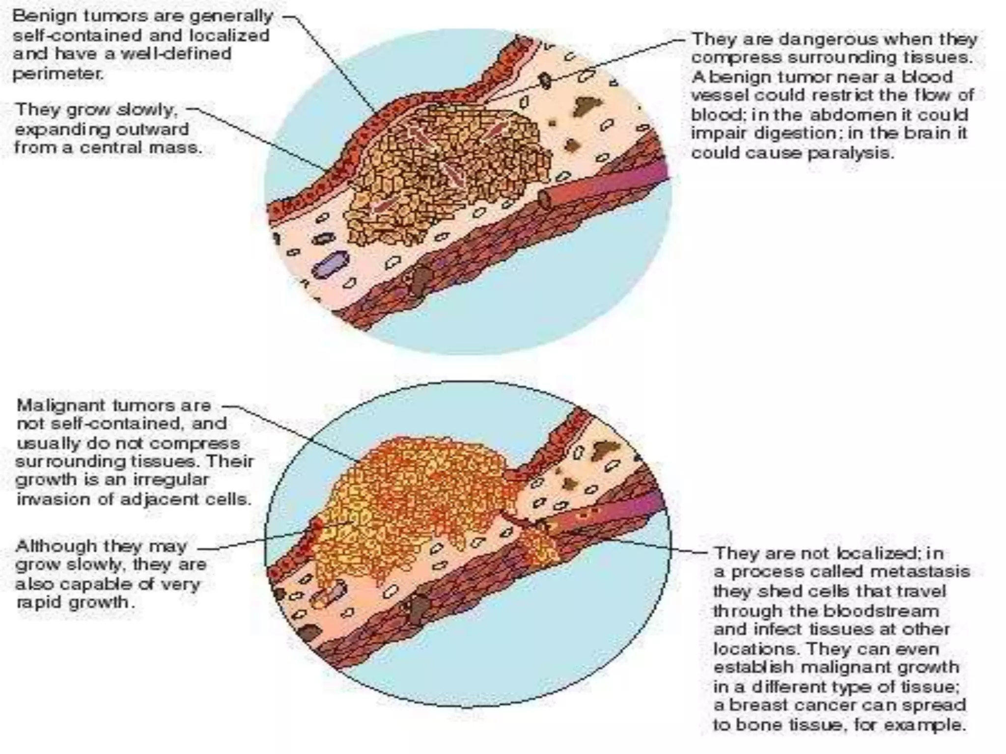 Benign and malignant tumor comparison | PPTX