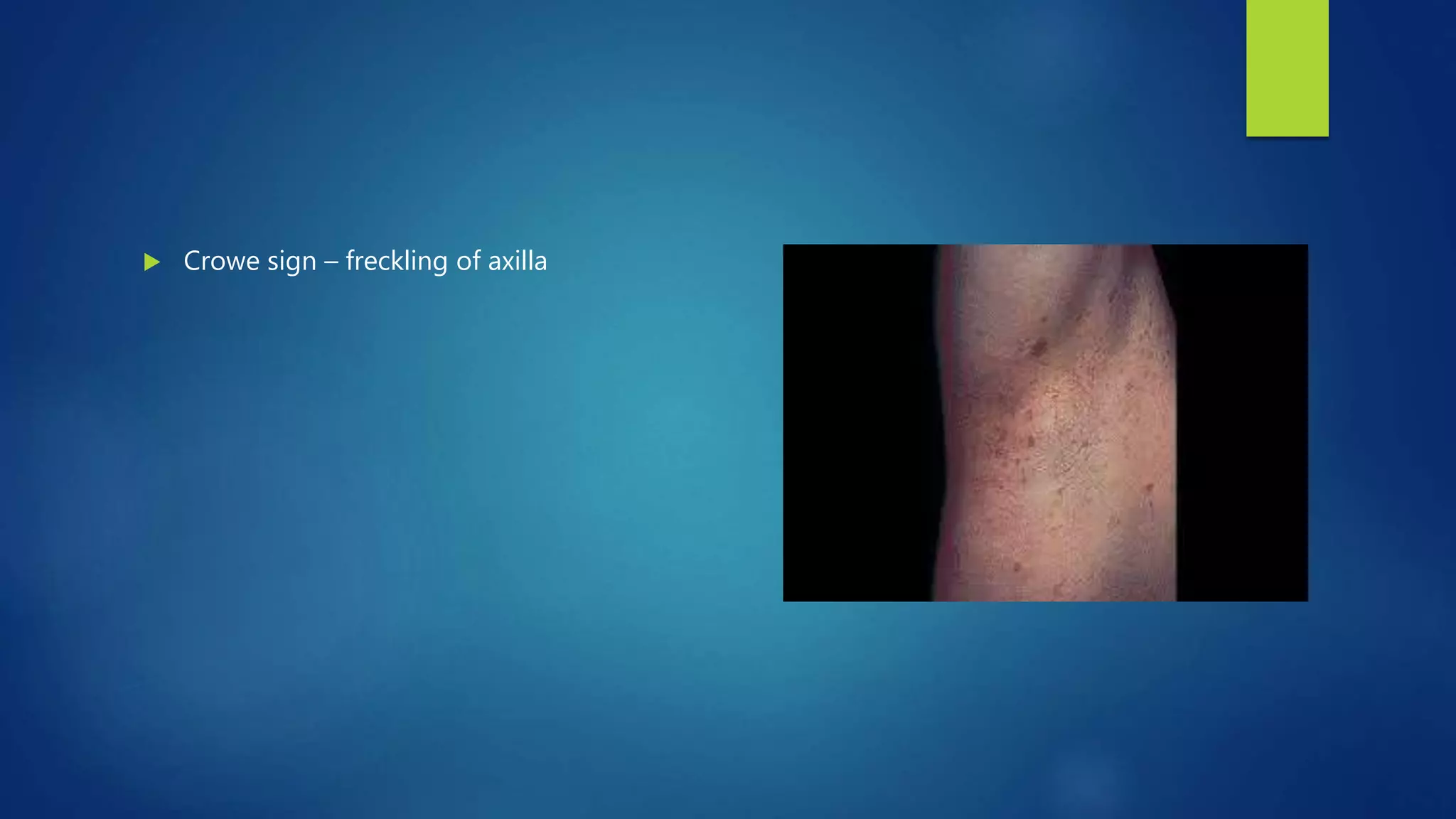 Benign and malignant nerve sheath tumors | PPTX