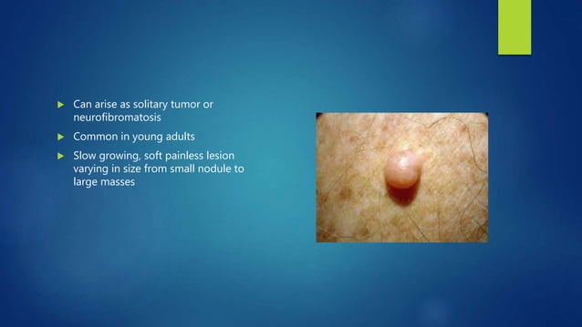 Benign and malignant nerve sheath tumors | PPTX