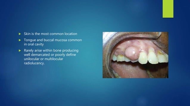 Benign and malignant nerve sheath tumors | PPTX