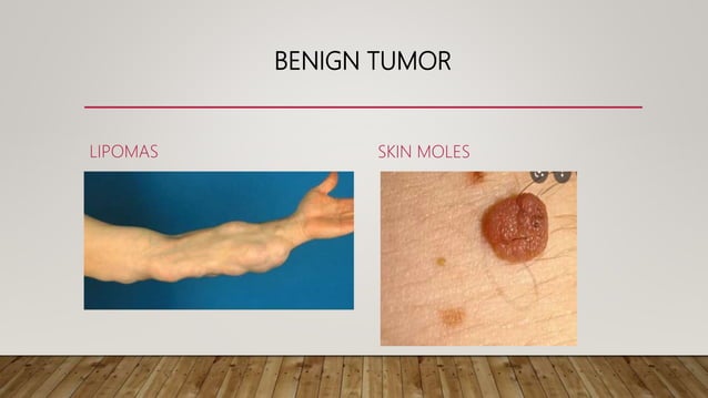 Benign and Malignant tumors | PPTX | Cancer | Diseases and Conditions