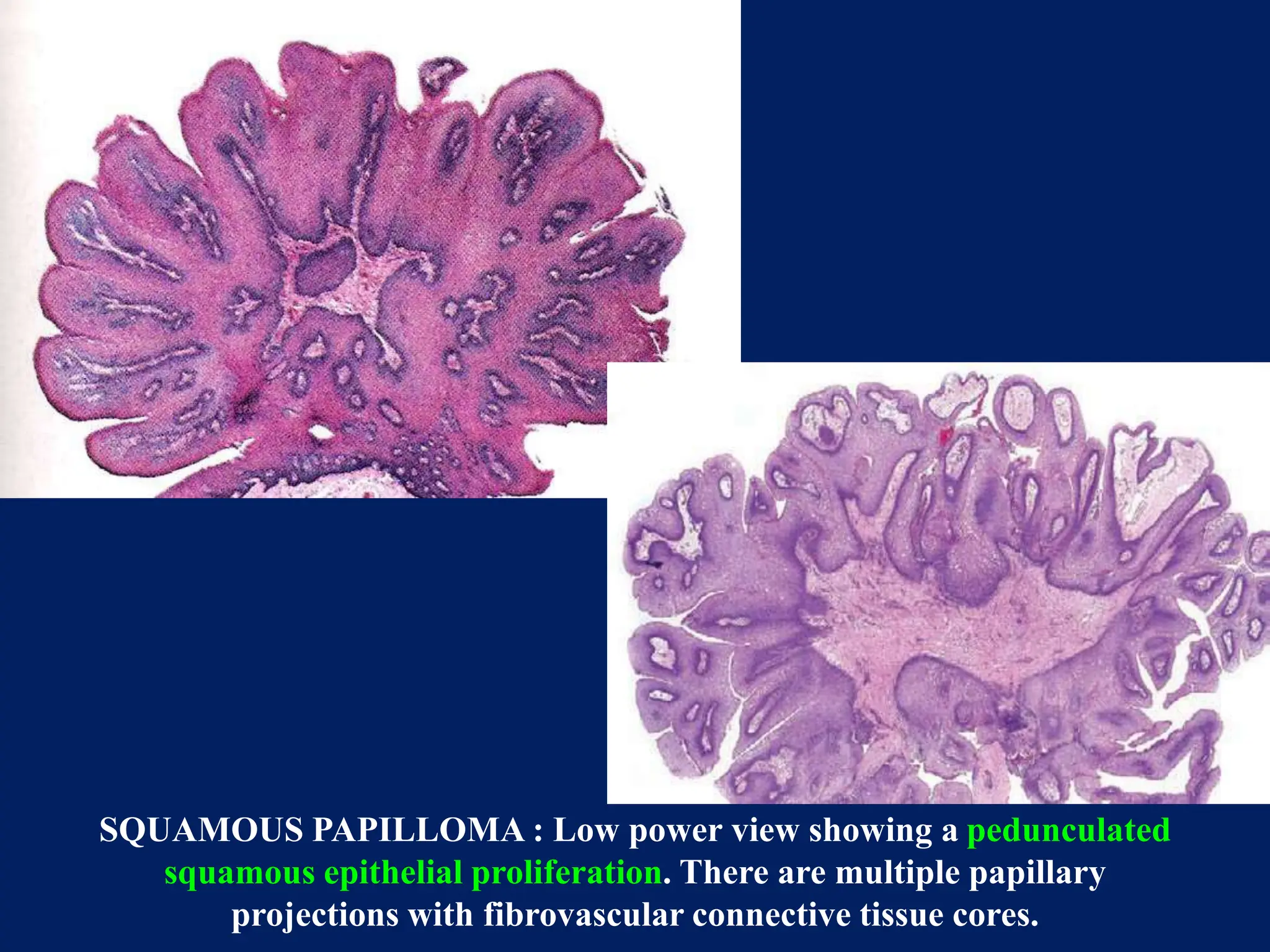 benign tumors of epithelial origin of oral cavity | PPTX