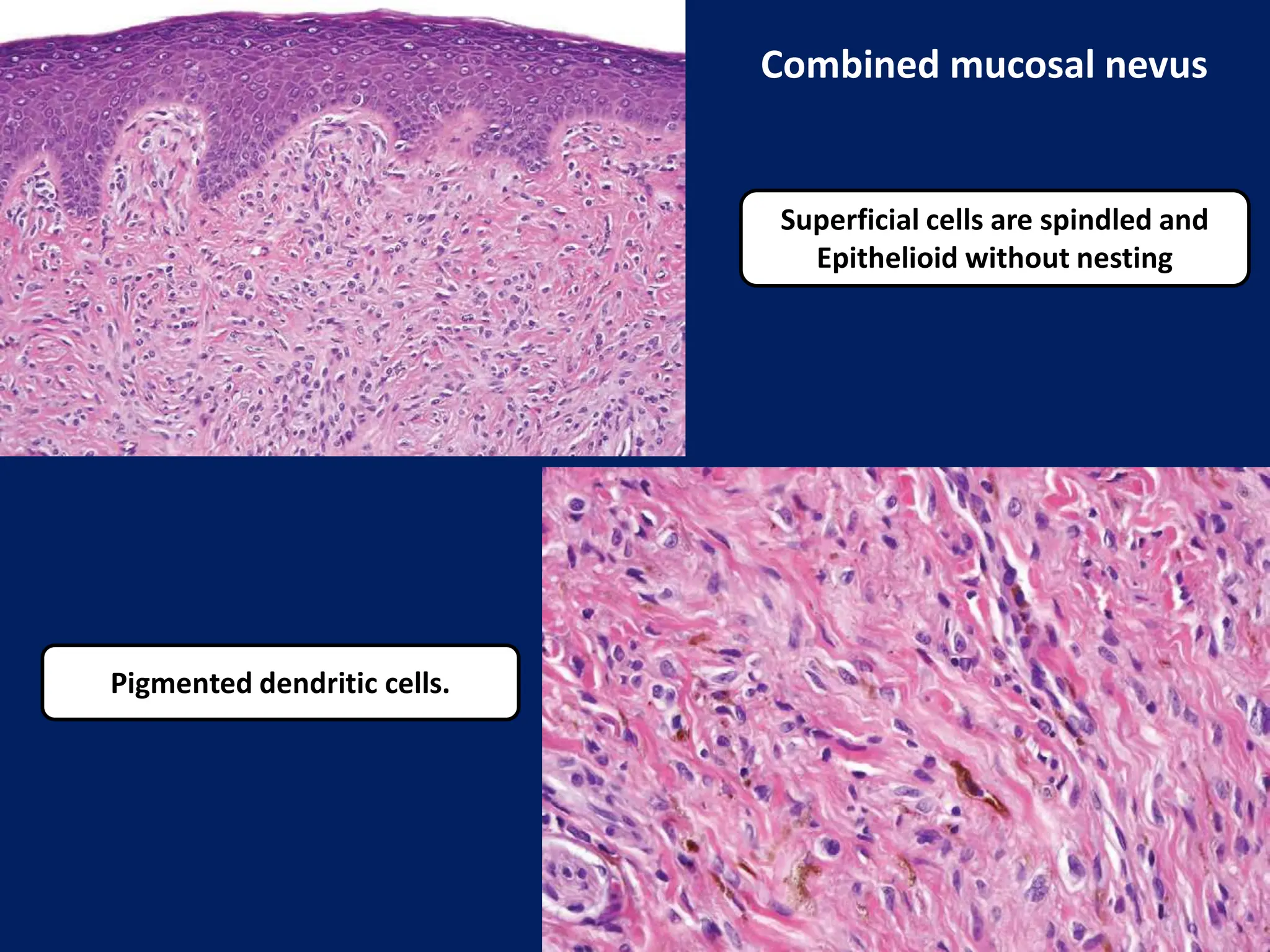 benign tumors of epithelial origin of oral cavity | PPTX