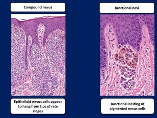 benign tumors of epithelial origin of oral cavity | PPTX