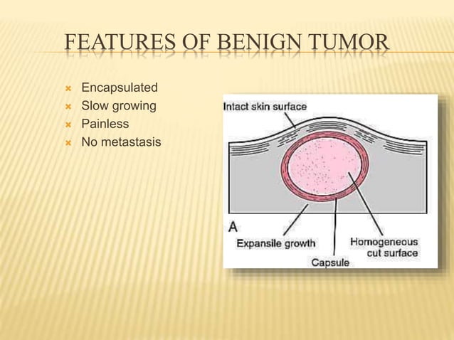 Benign and Malignant Tumours | PPTX
