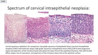benign and premalignant lesions of cervix (2).pdf