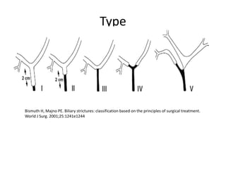 Benign biliary stricture | PPTX