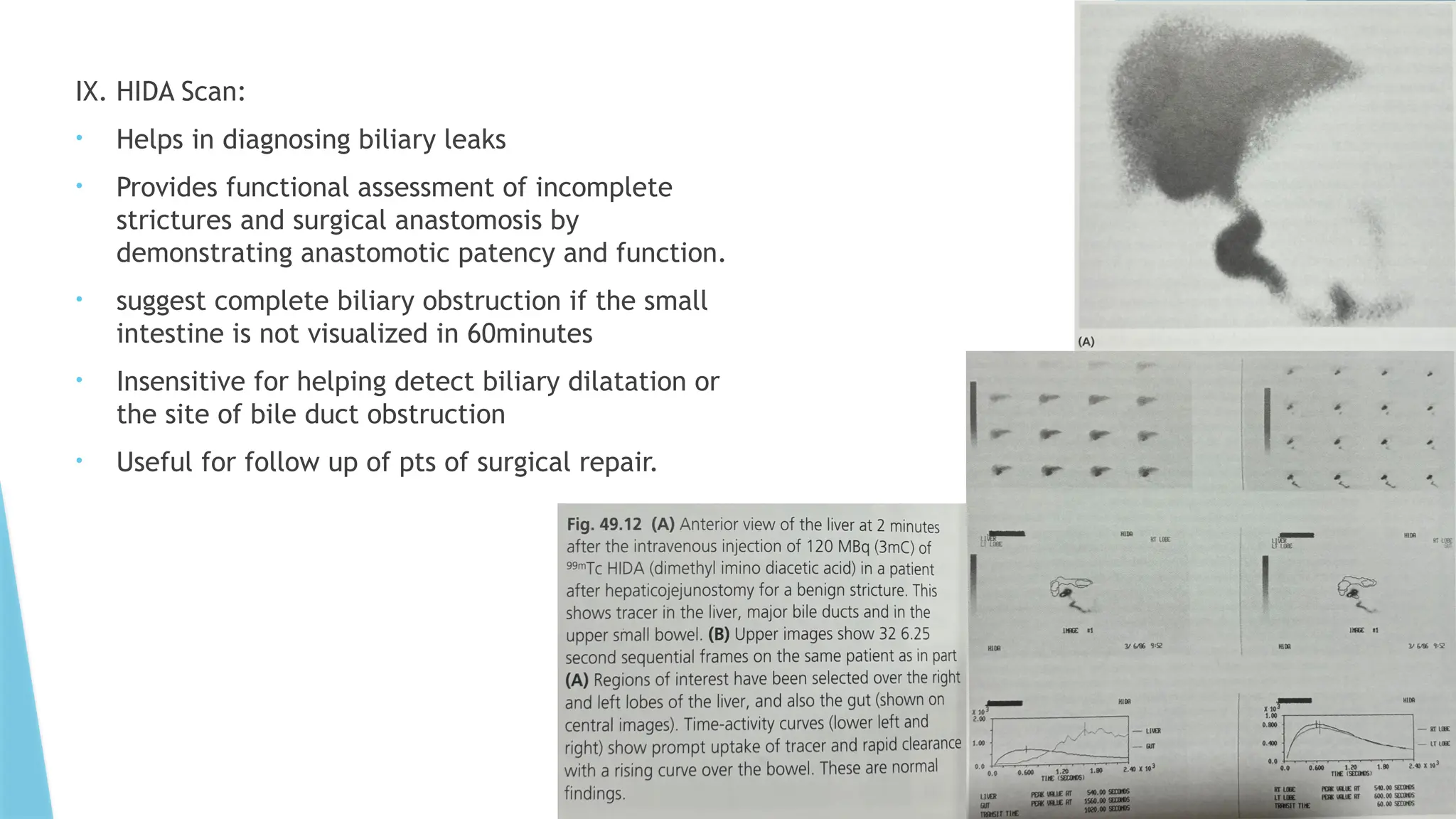 Benign biliary stricture of common bile duct 2.pptx