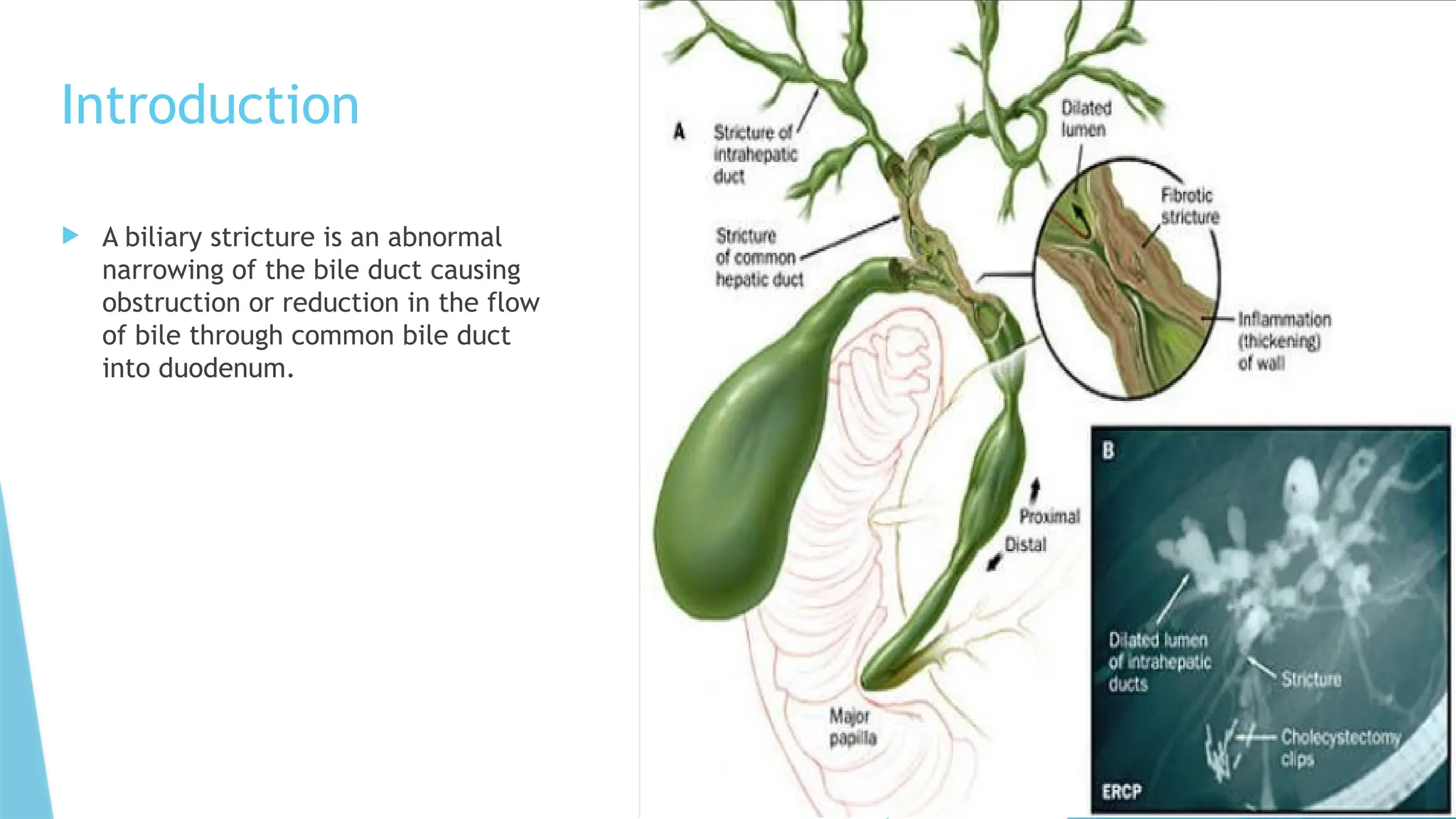 Benign biliary stricture of common bile duct 2.pptx