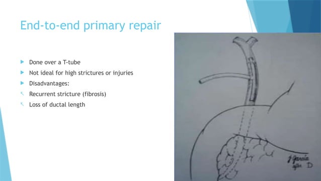 Benign biliary stricture of common bile duct 2.pptx