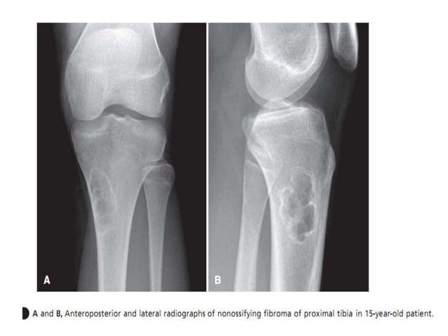 Benign bone lesion 1 | PPT
