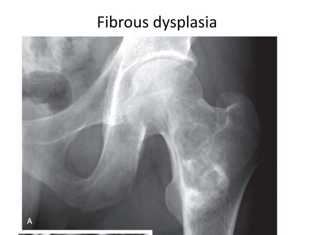 Benign bone lesion 1 | PPT
