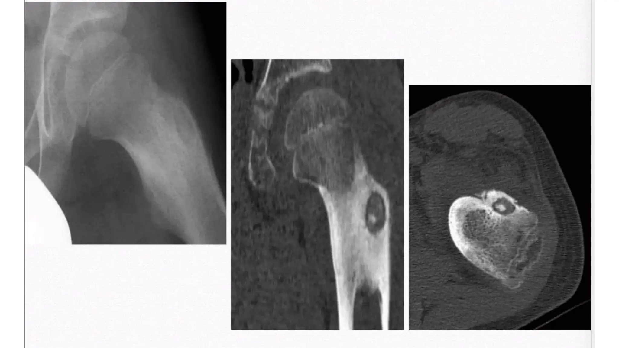 benign bone lesions x ray radiology guide.pdf