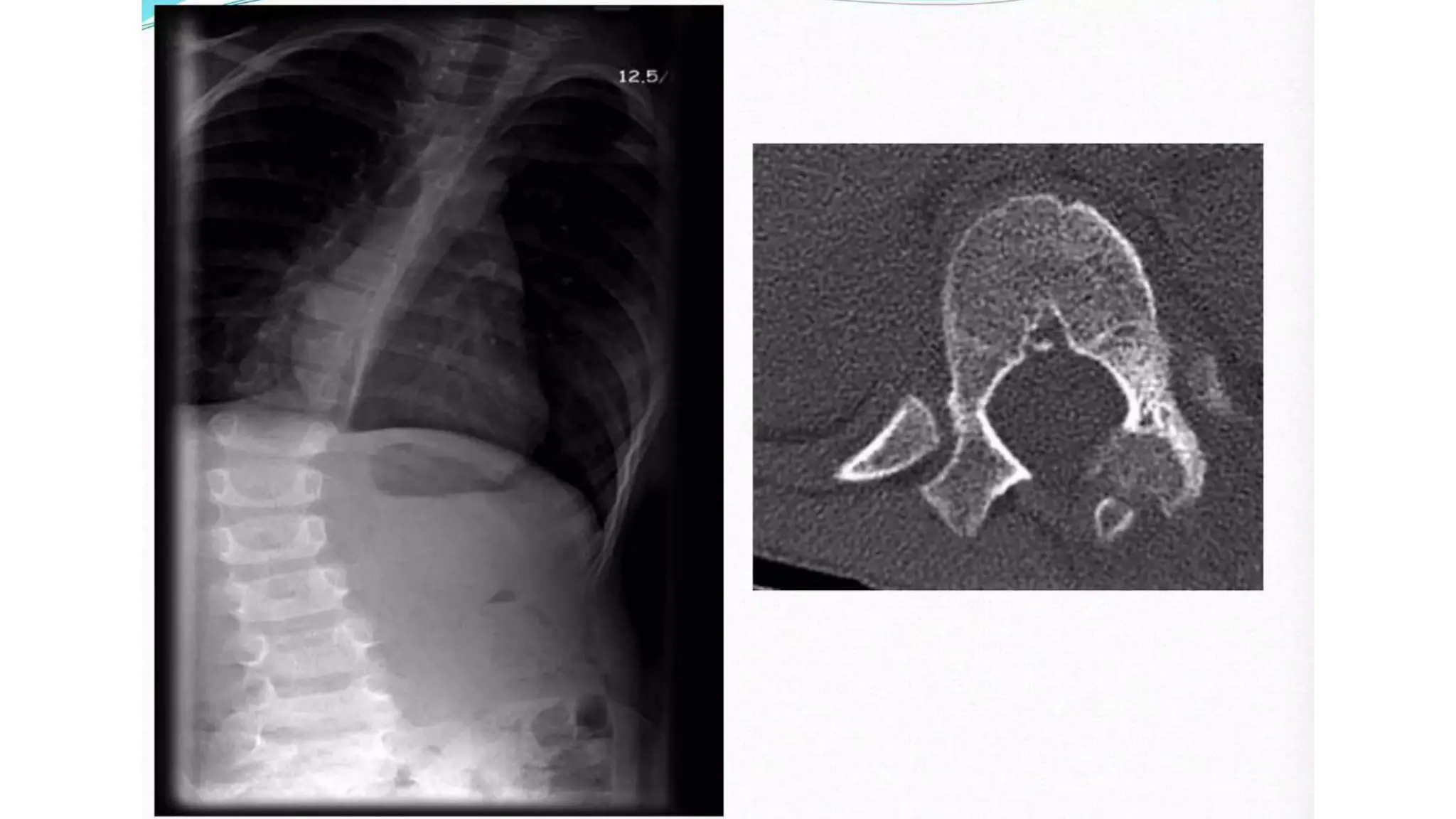 benign bone lesions x ray radiology guide.pdf
