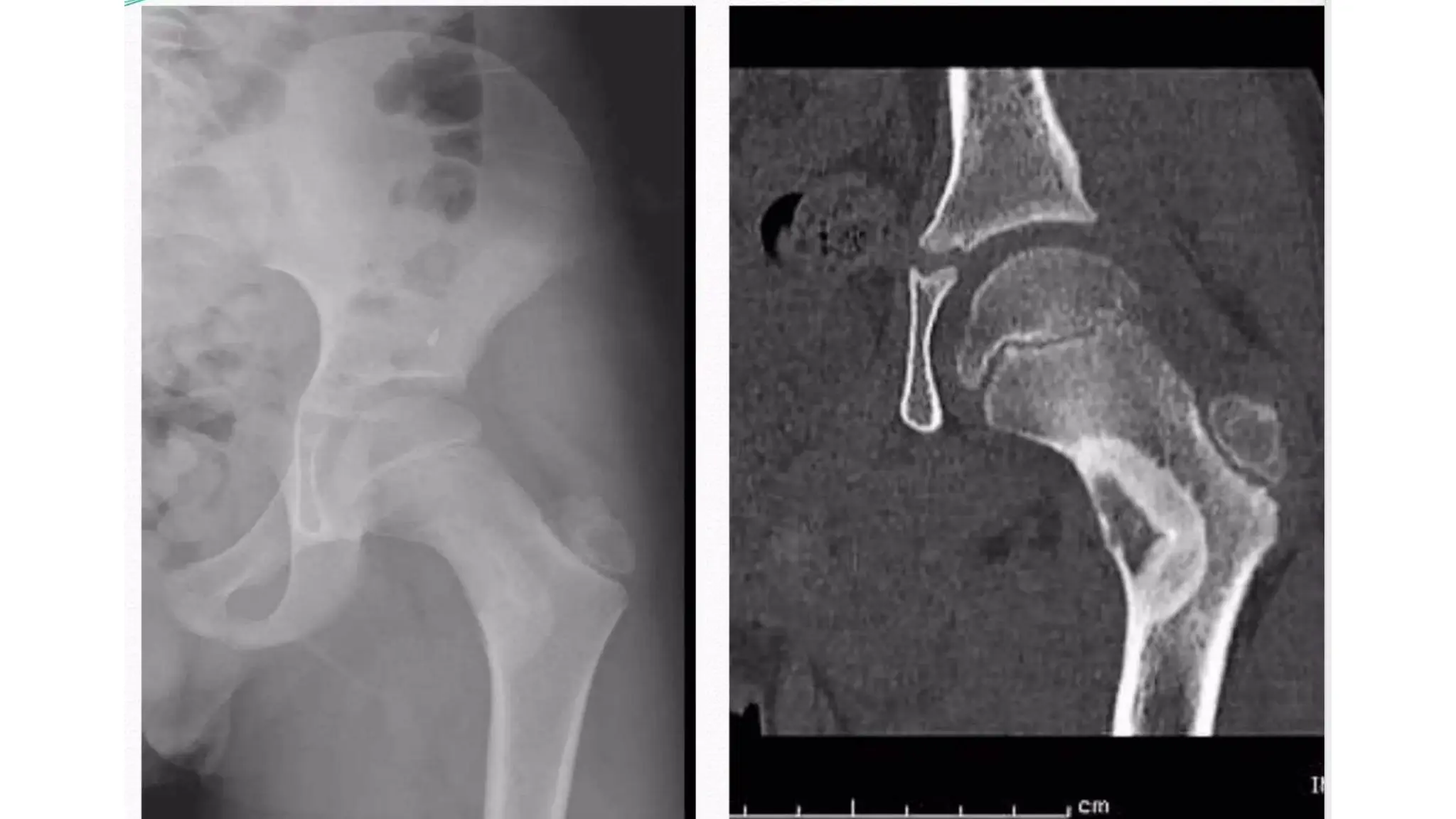 benign bone lesions x ray radiology guide.pdf