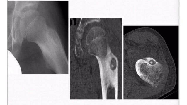 benign bone lesions x ray radiology guide.pdf