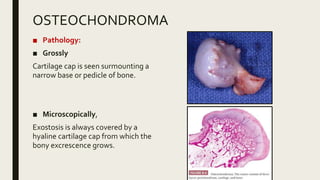 Benign bone tumor. | PPTX
