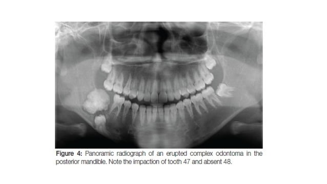 Benign Bone. Tumor of the Jaw.pptx