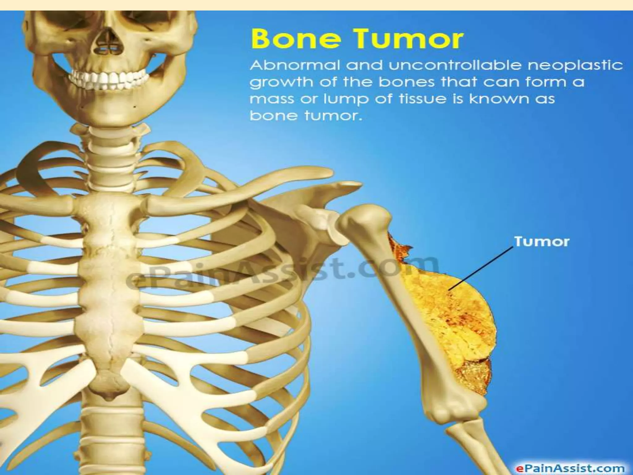 Benign bone tumor ppt | PPTX