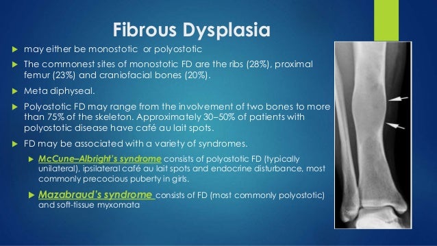 Benign bone tumors imaging