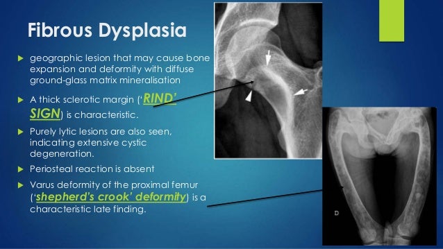 Benign bone tumors imaging