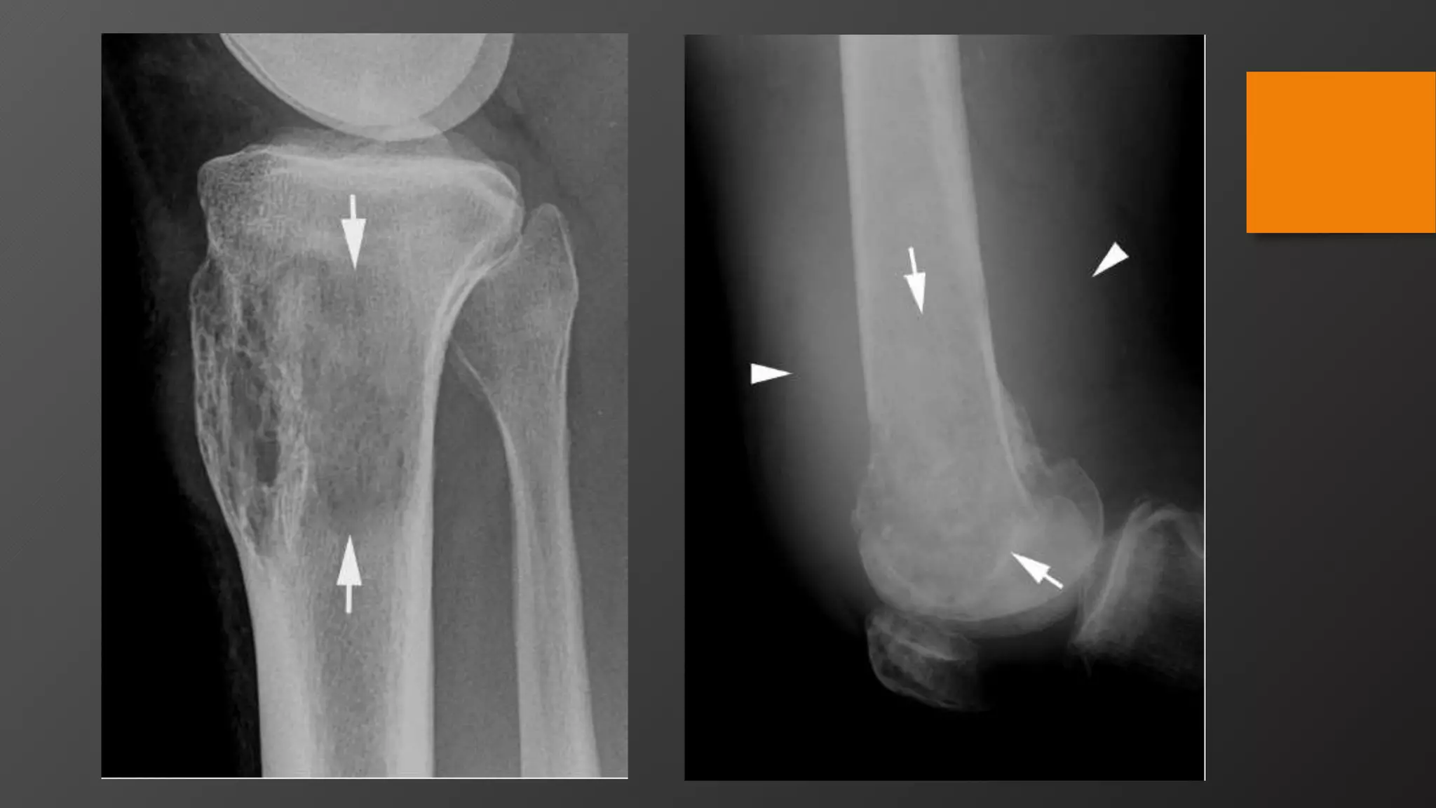 Benign bone tumors | PPTX