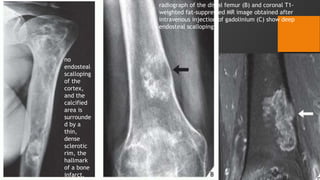 Benign bone tumors | PPTX