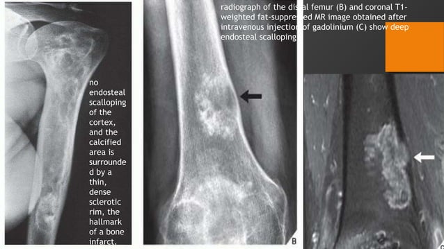 Benign bone tumors | PPT