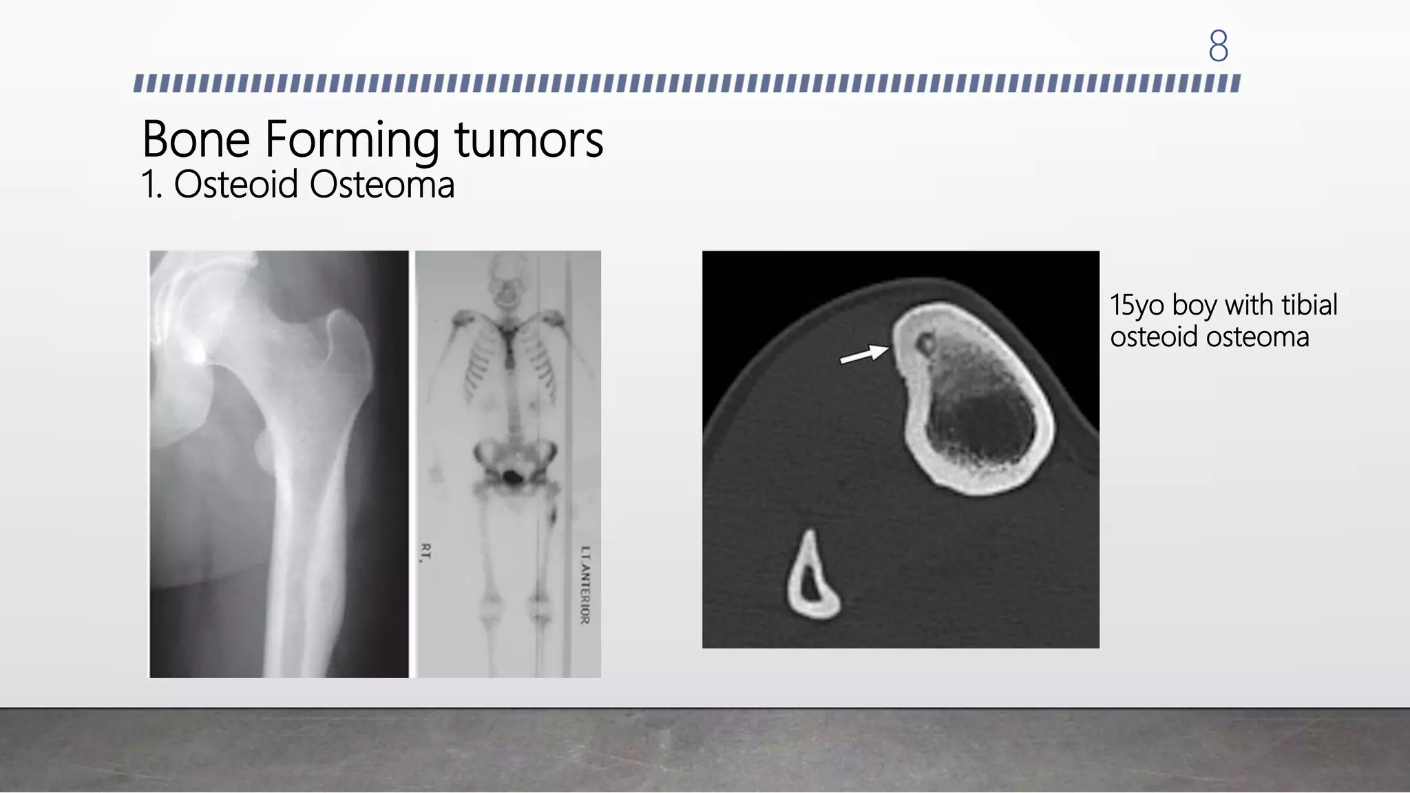 Benign bone tumors | PPT