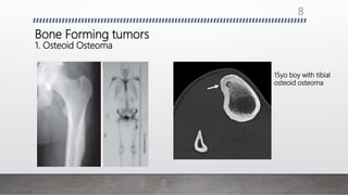 Benign bone tumors | PPT