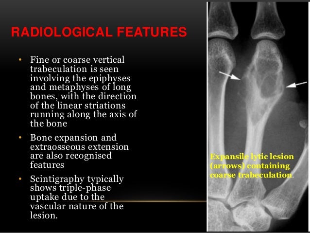 Benign bone tumors an approach