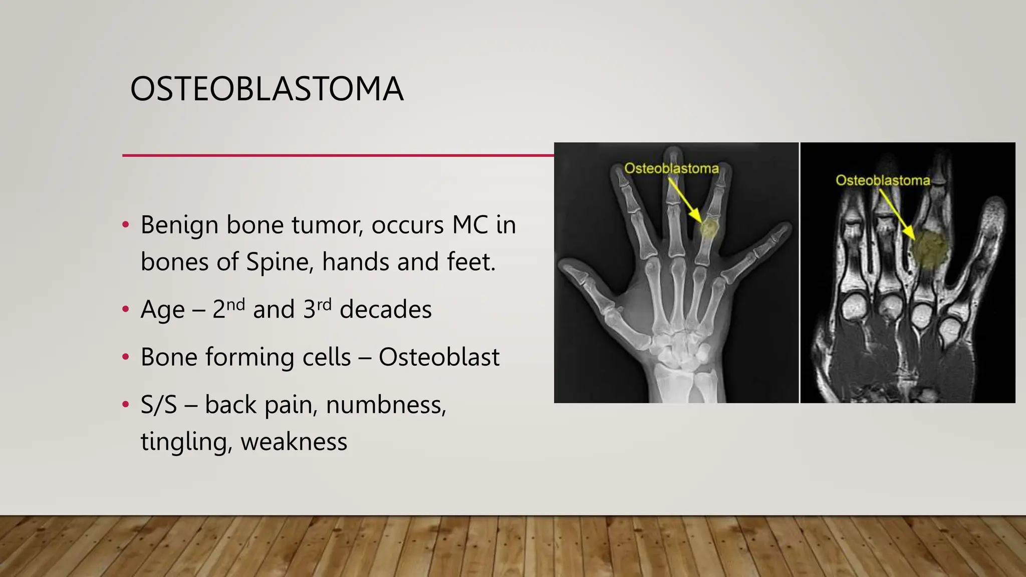 Benign bone tumors (Nutshell) | PPTX